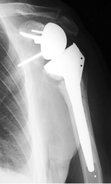 UW Shoulder and Elbow Academy: Scapular notching in reverse shoulder ...