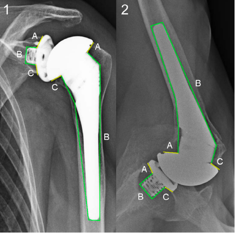 Shoulder Arthritis / Rotator Cuff Tears / Shoulder Pain : Stemless ...