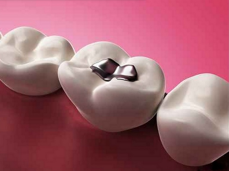 ¿Qué es el síndrome de la amalgama dental? ~ Info Acúfeno
