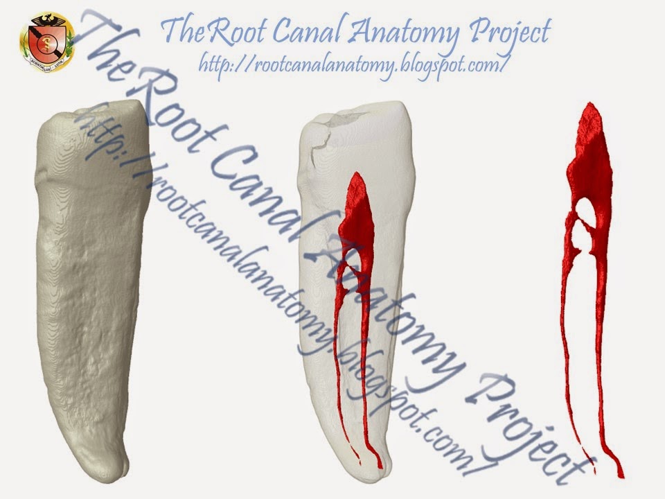The Root Canal Anatomy Project: Mandibular First Premolar: Two Root Canals