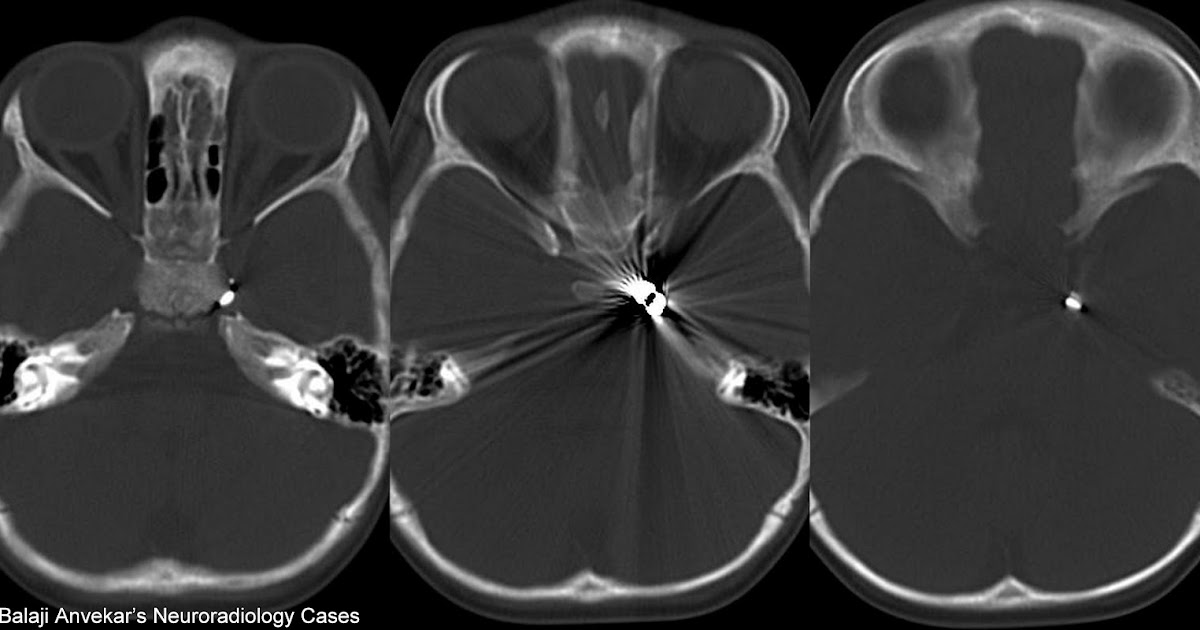Dr Balaji Anvekar FRCR: Intracranial extension of Shotgun pellet ...