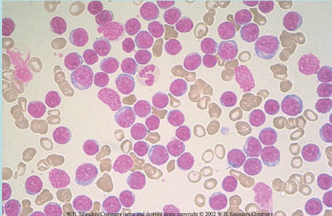 Células sanguíneas: Leucemia Linfoide y Mieloide Crónica