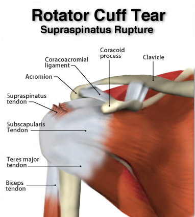 MYO Therapy & Healthcare Institute: Rotator Cuff Tears