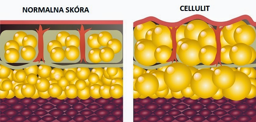 Kosmetolog radzi: Goodbye cellulite :)