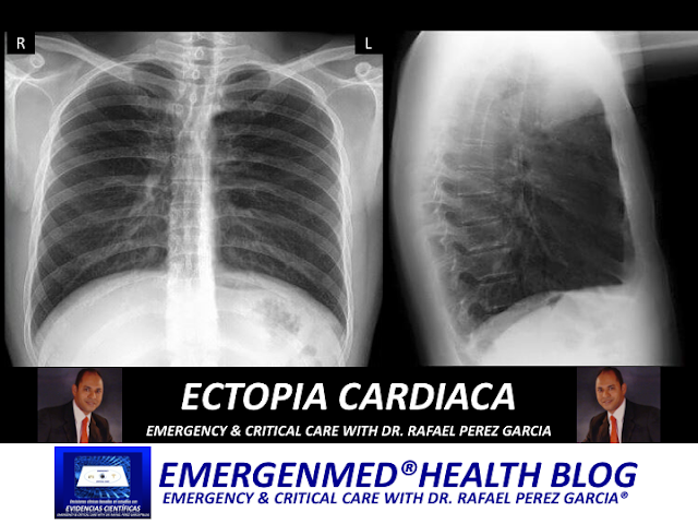 EmergenMed Health Blog: Ectopia Cardiaca Abdominal