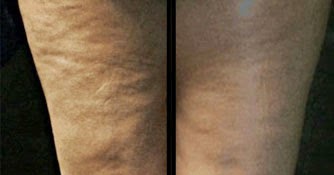 Fakta menarik mengenai selulit written by dr Gerry Wonggokusuma , Dipl ...