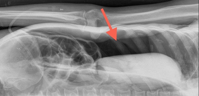 RADIOLOGIA LLEIDA: AIRE LIBRE INTRABDOMINAL. ¿ COMO RECONOCERLO
