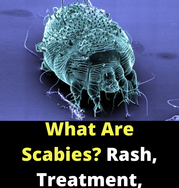 What Are Scabies? Rash, Treatment, Symptoms, Pictures - healhty and tips
