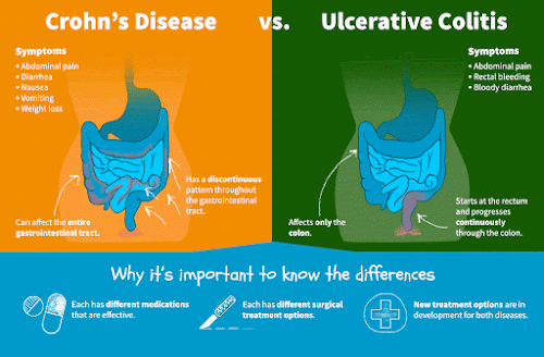 Medical for Us: Difference Between Irritable Bowel Syndrome (IBS) and ...