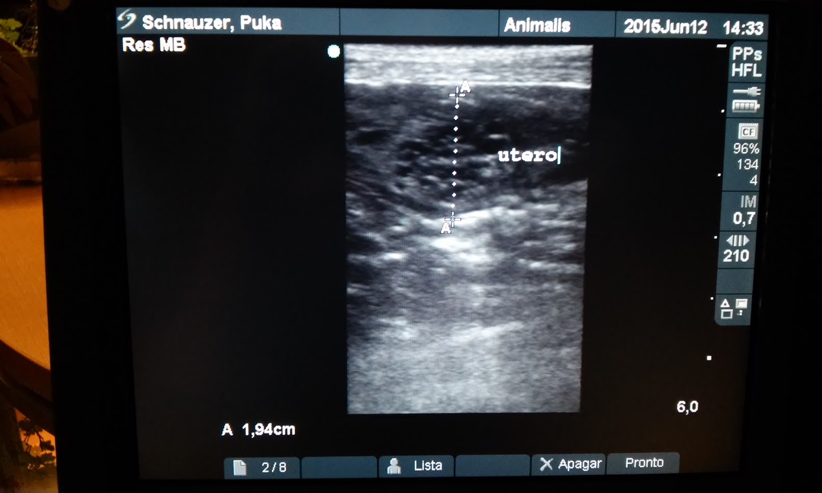 Hiperplasia endometrial cística