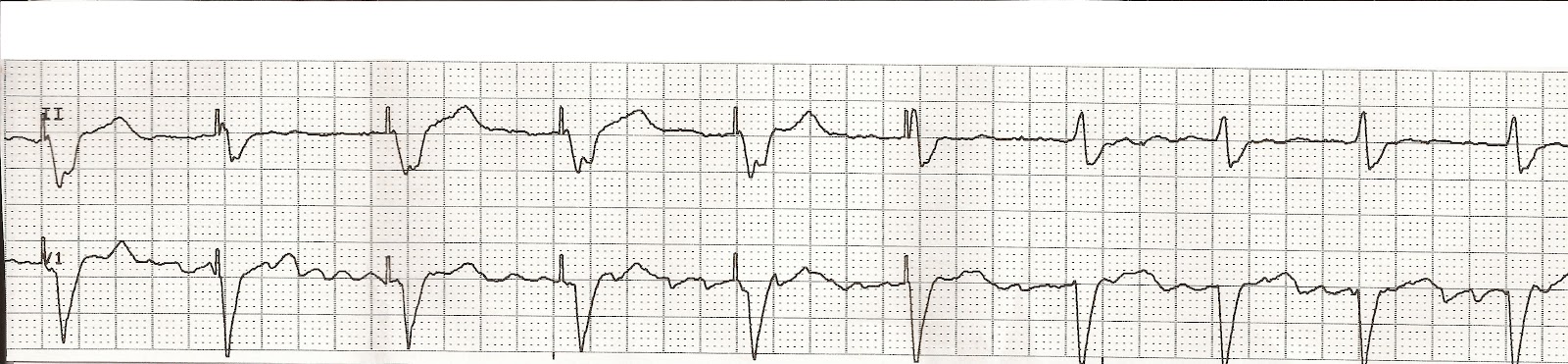 EKG Rhythm Strip Quiz 44