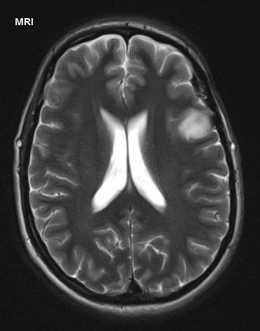 Diffuse astrocytoma (WHO Grade II)