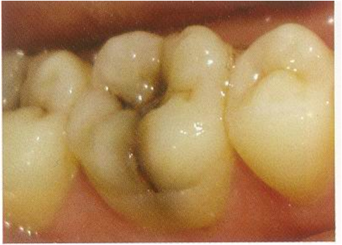 dentalaka: Dental Caries definition, Classification of Dental Caries ...