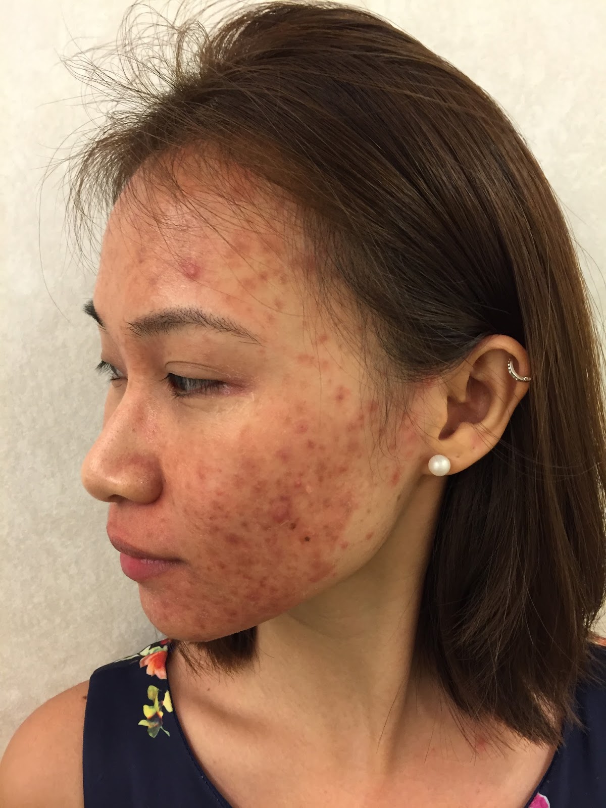 Dr Gerard Ee | Clifford: AGNES and Q-switch laser. The treatment for ...