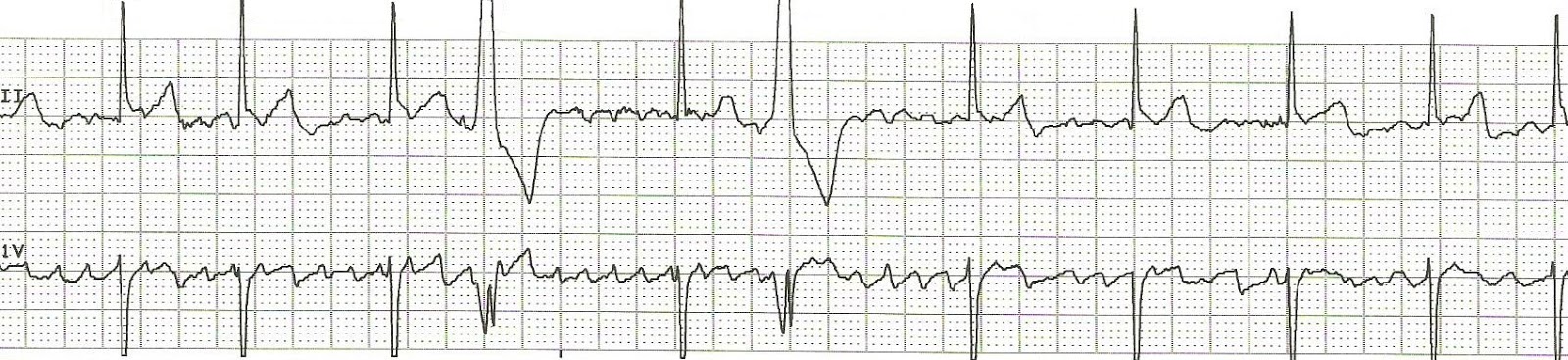ECG Rhythm Strip Quiz 61