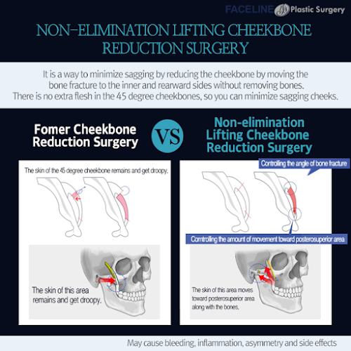 What's important when you reduce your cheekbones!