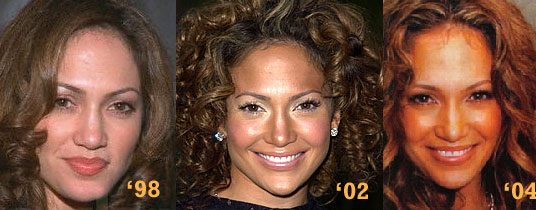 Jennifer Lopez Plastic Surgery Before and After Botox Injections ...