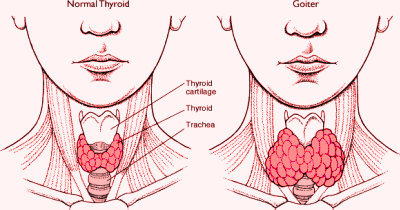 Cara Melihat Gejala Hipotiroid dan Hipertiroid - Artikel Kesehatan