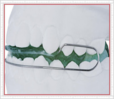 Функционални ортодонтски апарати ~ Медико-техническа ортодонтска ...