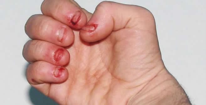 Doctors warned about Nail Biting habit that leads to body necrosis ...
