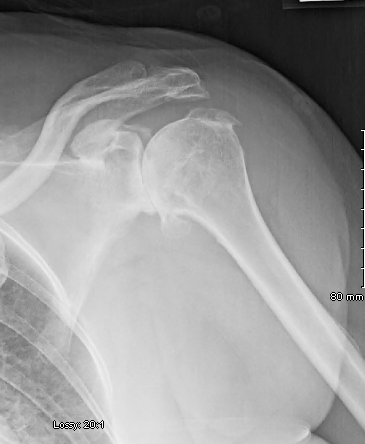 Shoulder and Elbow Surgery: "Bone spurs" and shoulder replacement surgery