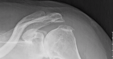Shoulder and Elbow Surgery: "Bone spurs" and shoulder replacement surgery