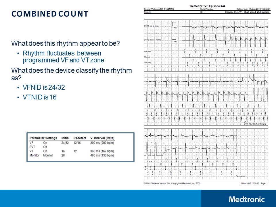 CVT Mohd Farid: Concept Of ICD Technology-Sensing & Detection-Medtronic ...