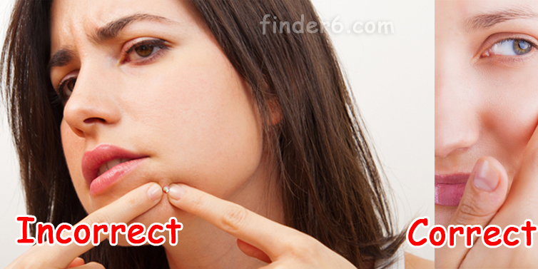 How To Properly Pop A Pimple Without Leaving Scar ~ Entertainment News ...