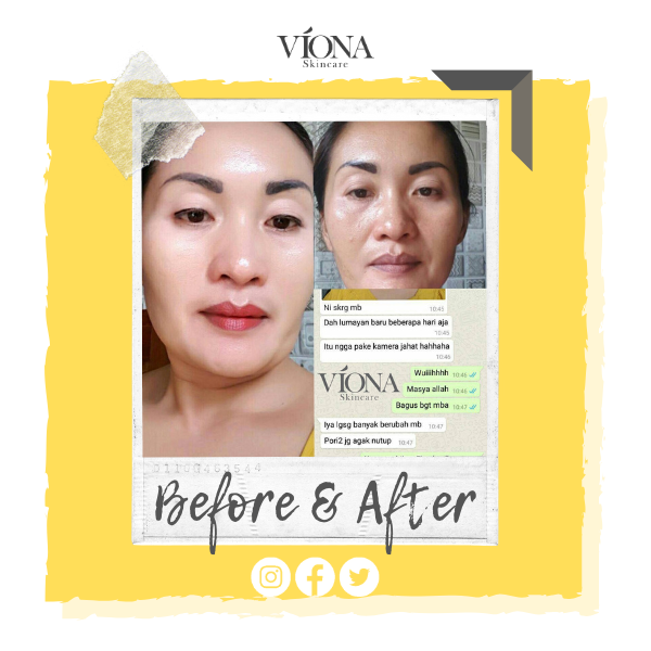Before After Customer Viona Skincare #6 - Viona Skincare