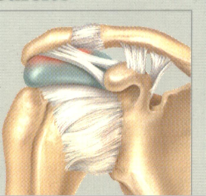 Patologias Teciduais: Bursite