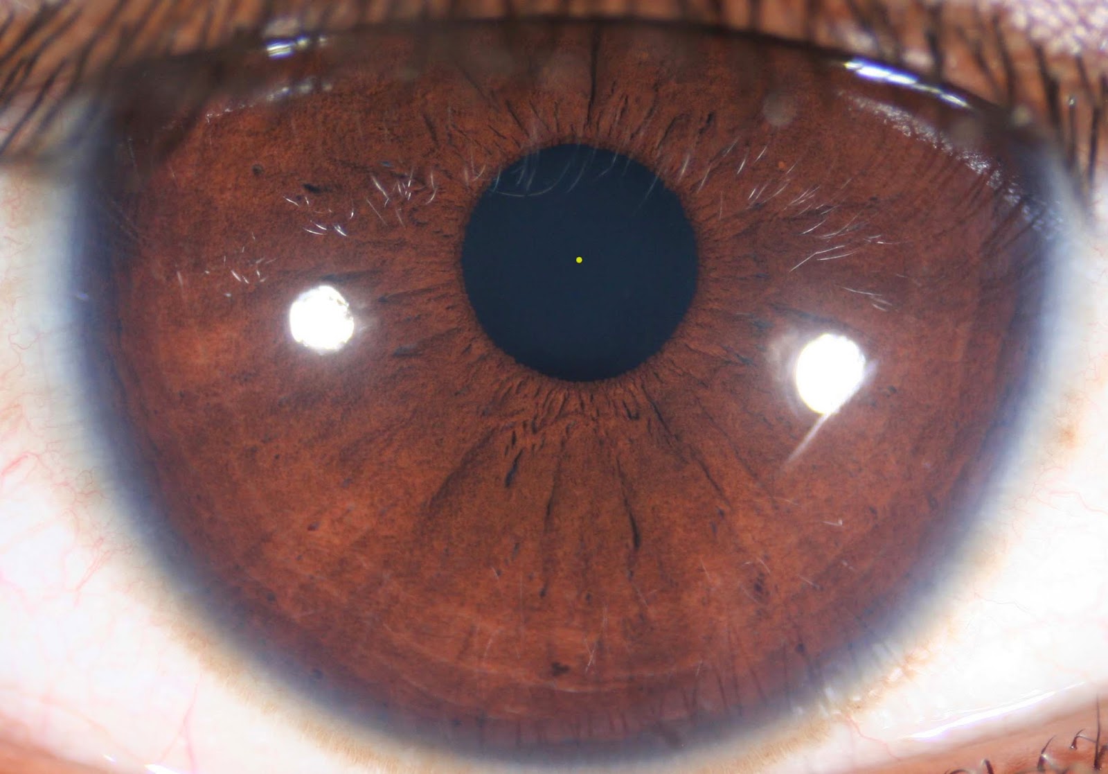 Modern & Multidimensional Iridology: Radial Furrows in Multidimensional ...