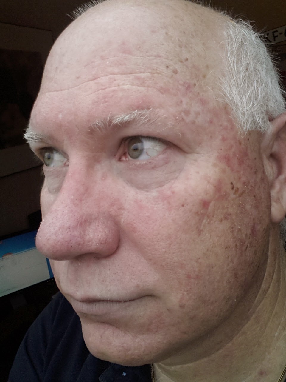 Resultaat gebruik Efudix: Dag 01