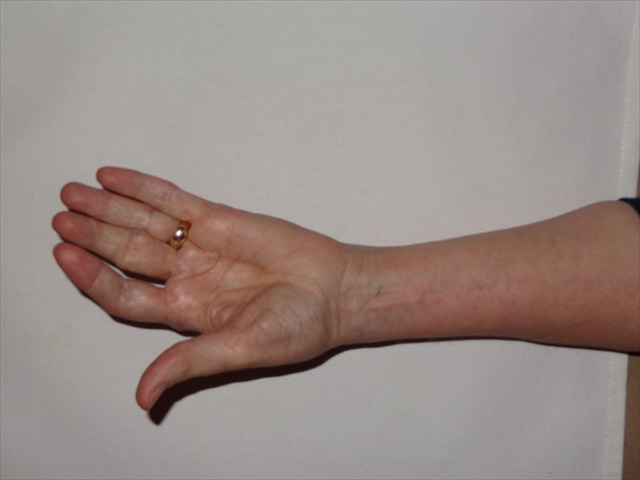 Here's Your Gold Watch - Rheutired: Wrist Fusion Surgery