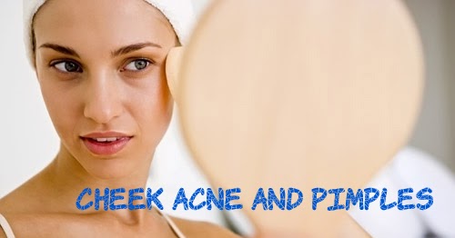 Cheek Acne and Pimples Solution ~ Get Rid of Acne in Just 1 Week