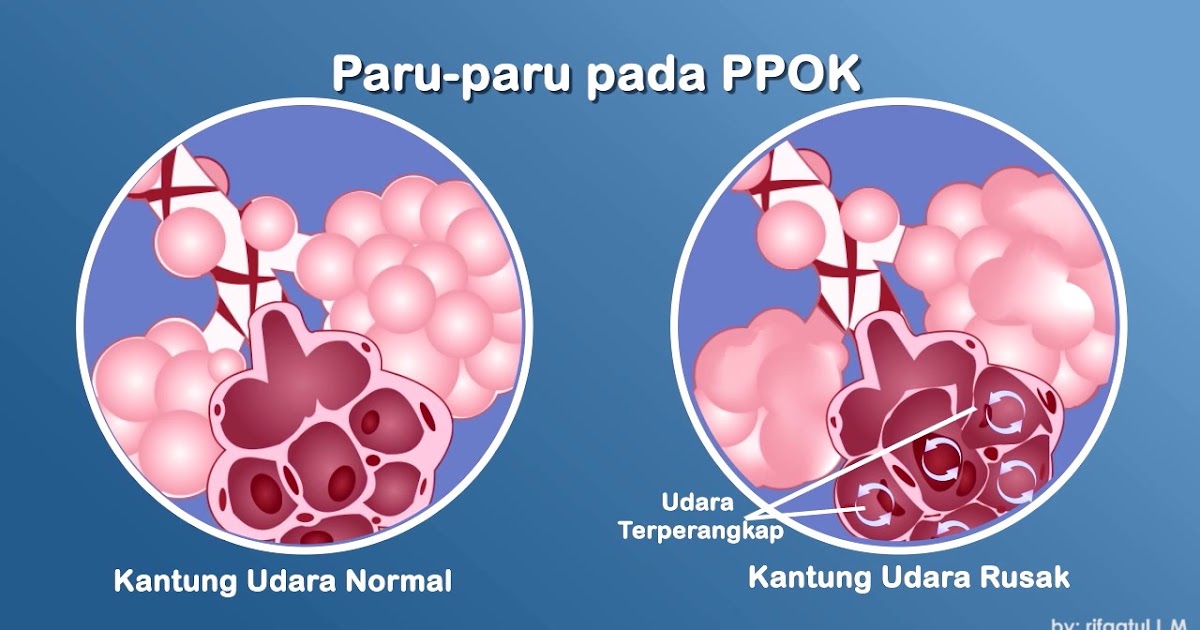 Bagaimana Cara Mudah Menyembuhkan Penyakit Paru Paru PPOK