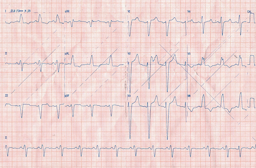 Blog de Eletrocardiografia: O BLOQUEIO DE RAMO ESQUERDO (BRE) COM ...