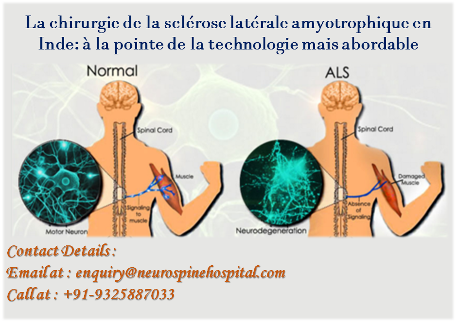 French to India Medical Travel: La chirurgie de la sclérose latérale ...