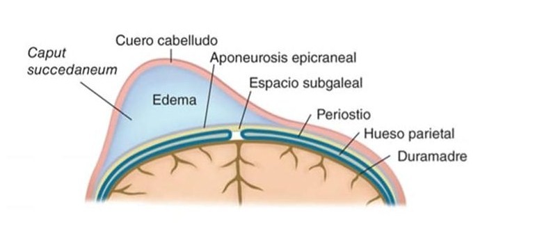 Nacer en Alcalá: CAPUT Y CEFALOHEMATOMA: ¿POR QUÉ MI BEBÉ HA NACIDO CON ...