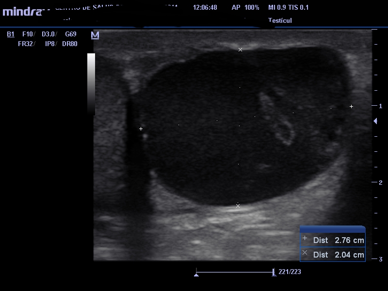 EcoCyl-Grupo: Hematoma escrotal