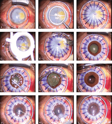 Ophthalmology Notes: Rings in ophthalmology