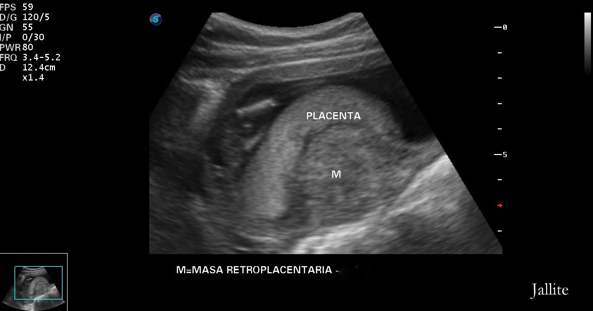 Placenta Percreta