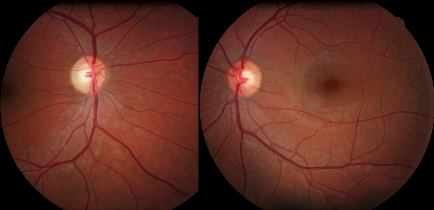 Devic’s Disease – Uncommon Neurological Ailment