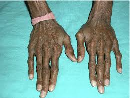 Enfermedades Raras, ¿y eso de qué va?