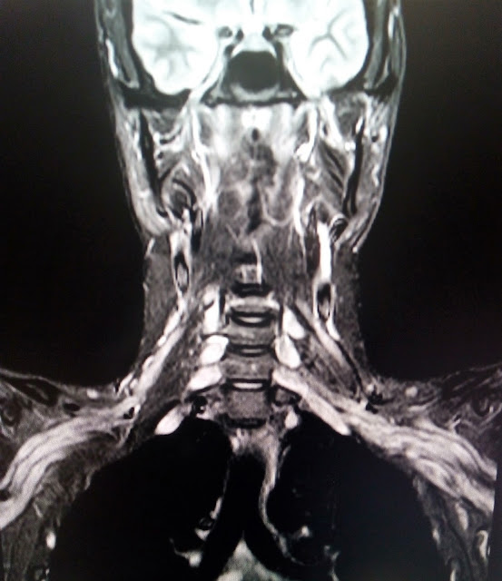 Chronic inflammatory demyelinating polyradiculoneuropathy (CIDP): MRI - Sumer's Radiology Blog