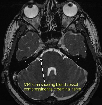 Understanding Trigeminal Neuralgia