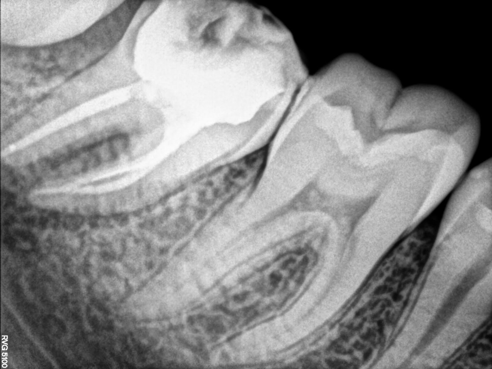 SevaDharma Dental Clinic: Re treatment of lower right second molar