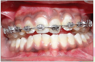 THE PIGGYBACK TECHNIQUE (double wire technique )