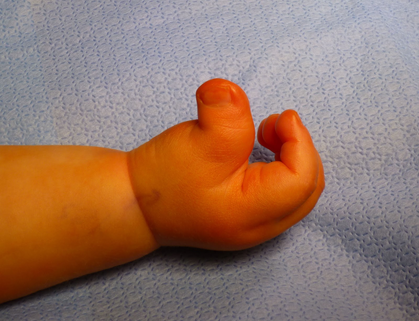 Clinodactyly | Congenital Hand and Arm Differences