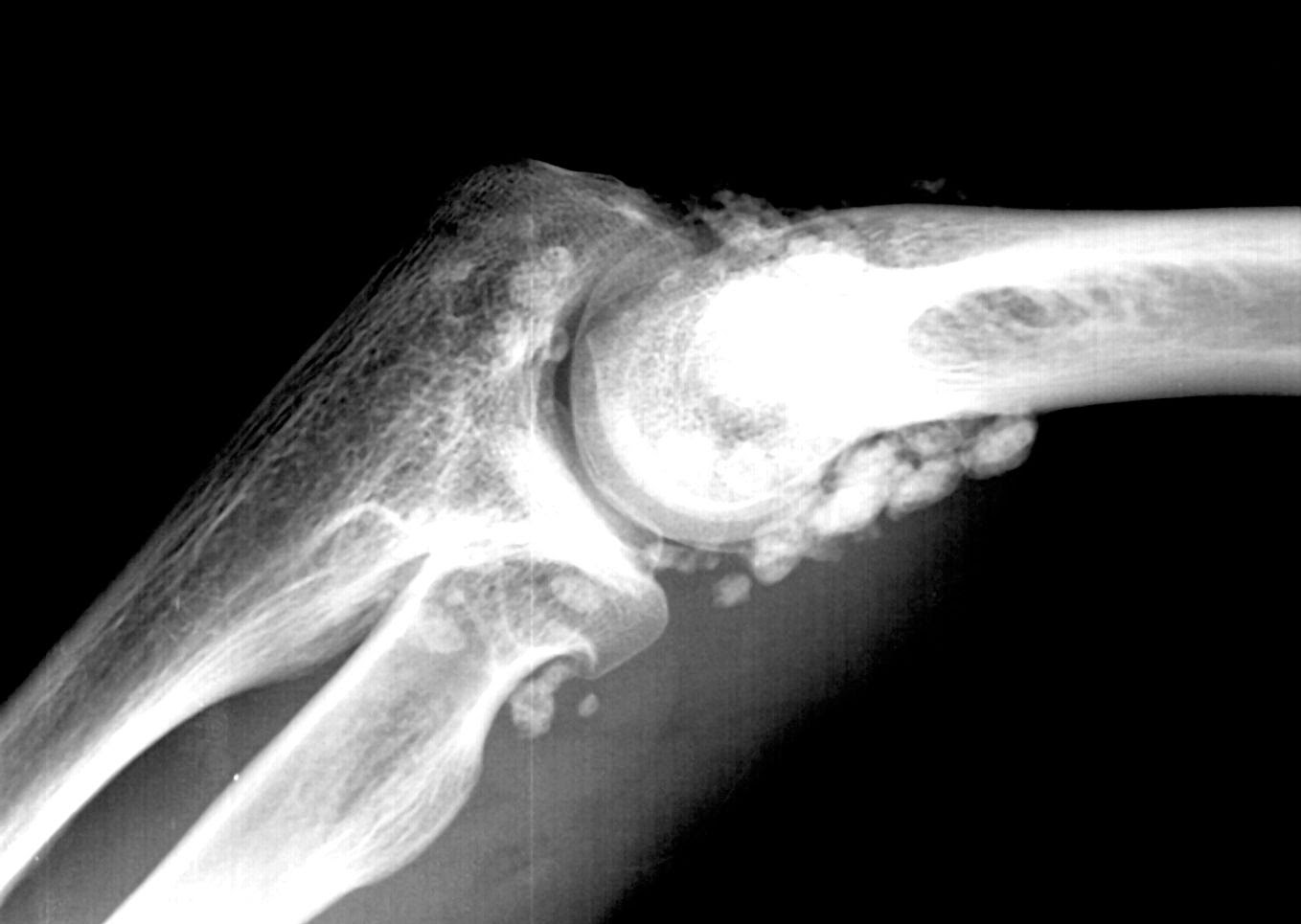 Medische Kennis: Synoviale chondromatose