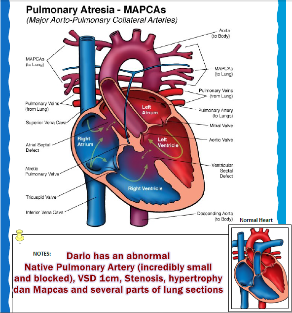 His Rare Case of CHD : Tetralogy of Fallot (ToF) with PA and MAPCAs ...